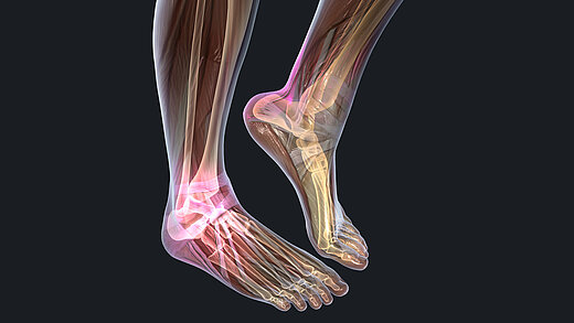 BIOLOX®delta a benchmark in modern ceramic joint replacement