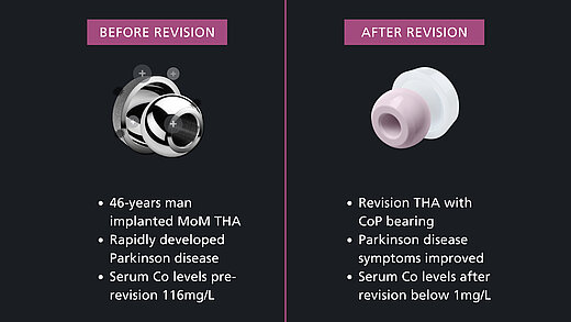 BIOLOX®delta a benchmark in modern ceramic joint replacement