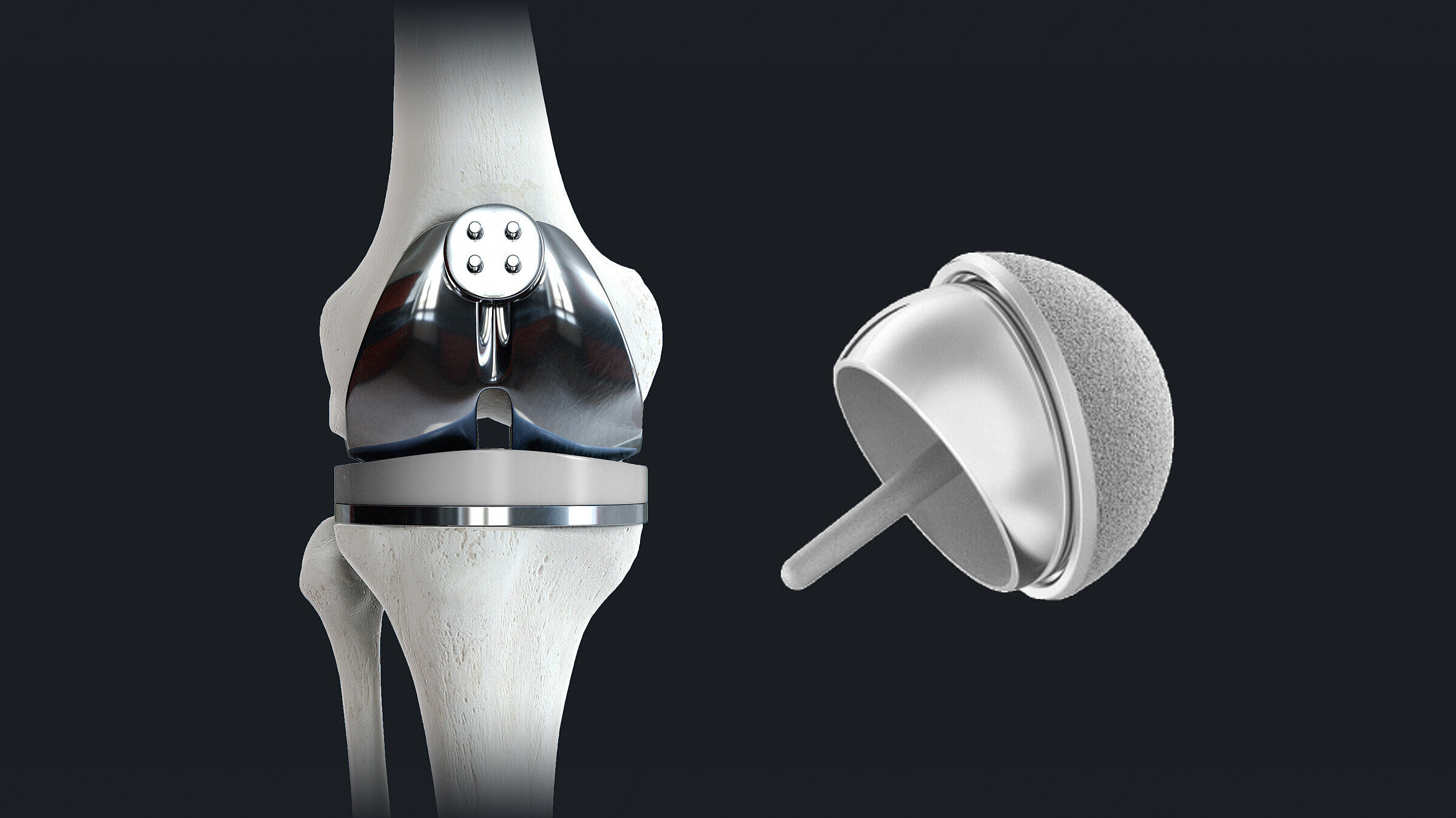 Cobalt ion release after total knee arthroplasty (TKA) higher than ...