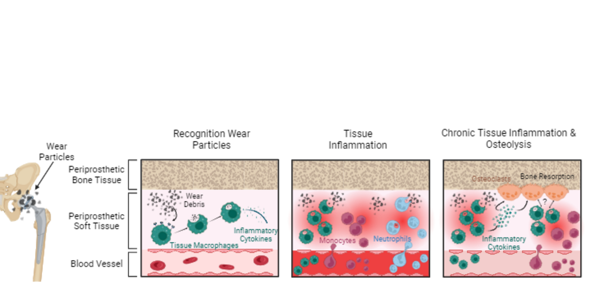 Under the microscope: understanding the immune dynamics of joint ...