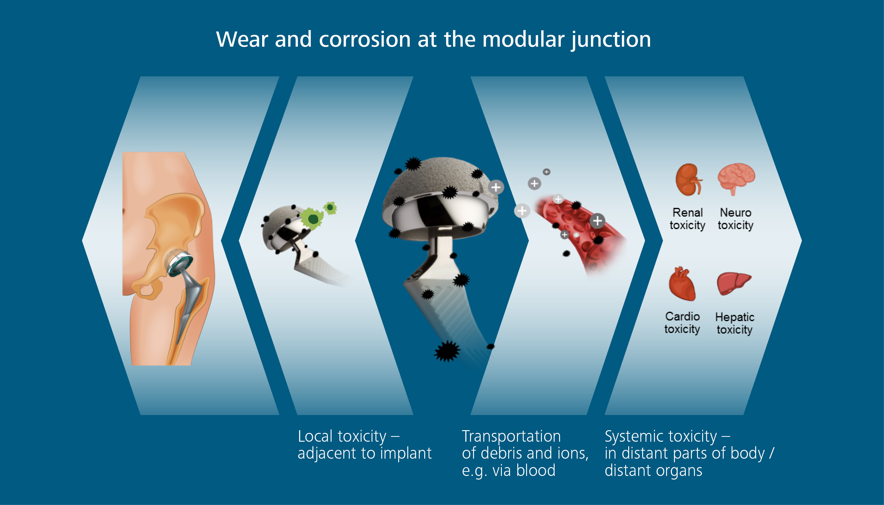 ANSM: Cardiac function to be monitored in patients with metallic heads